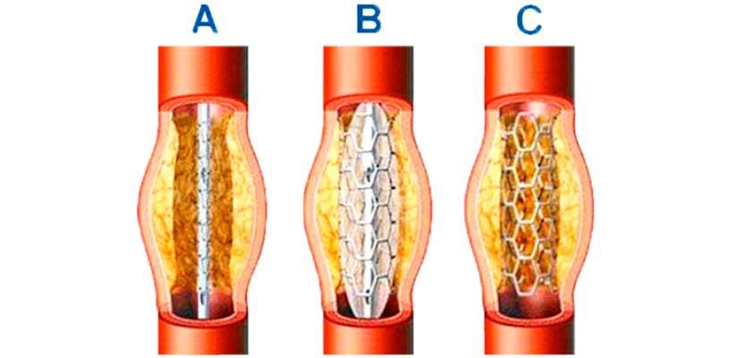 Angioplastía | actuamed